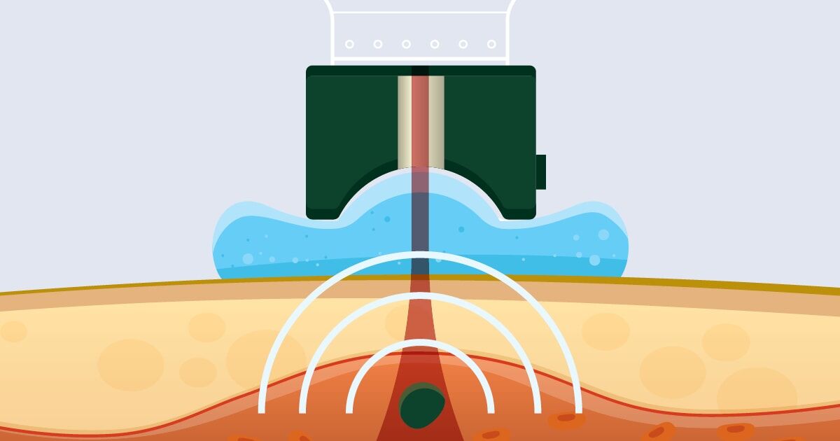 Luz e som para detectar células tumorais : Revista Pesquisa Fapesp