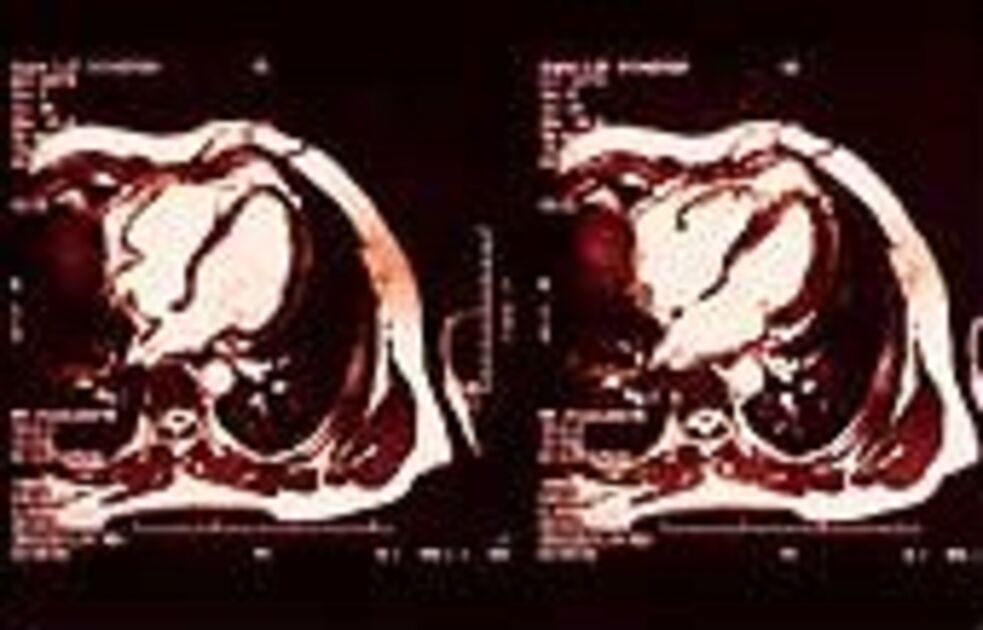 Restored heart : Revista Pesquisa Fapesp