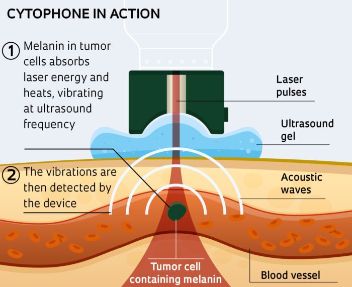Detecting tumor cells with light and sound : Revista Pesquisa Fapesp