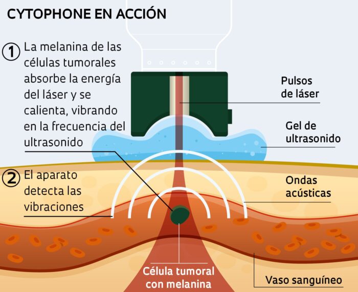 Luz y sonido para detectar células tumorales : Revista Pesquisa Fapesp